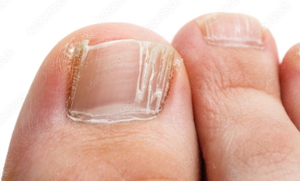 Understanding and Addressing Cracked Nails: 5 Causes and Remedies for ...