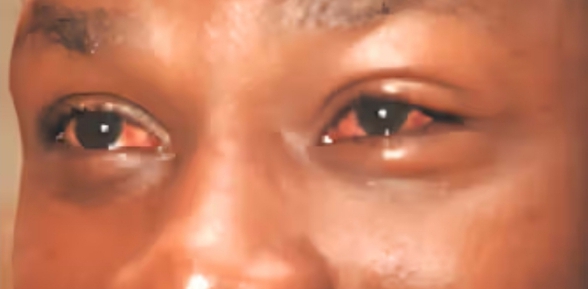 Understanding and Managing Red Eye Disease: Causes, Symptoms, and ...